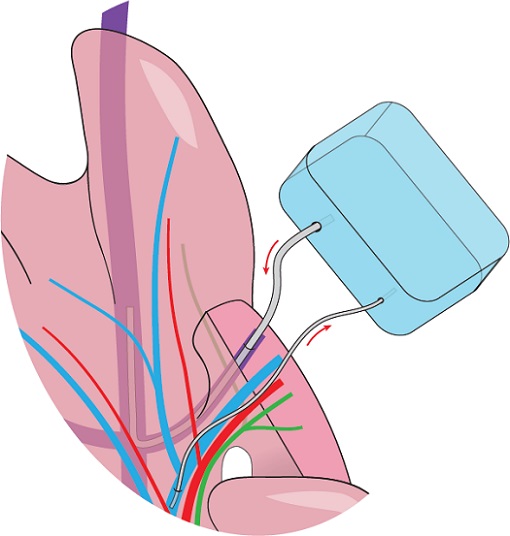 Veryst supports bioengineering study of new surgical technique, just published | Veryst Engineering